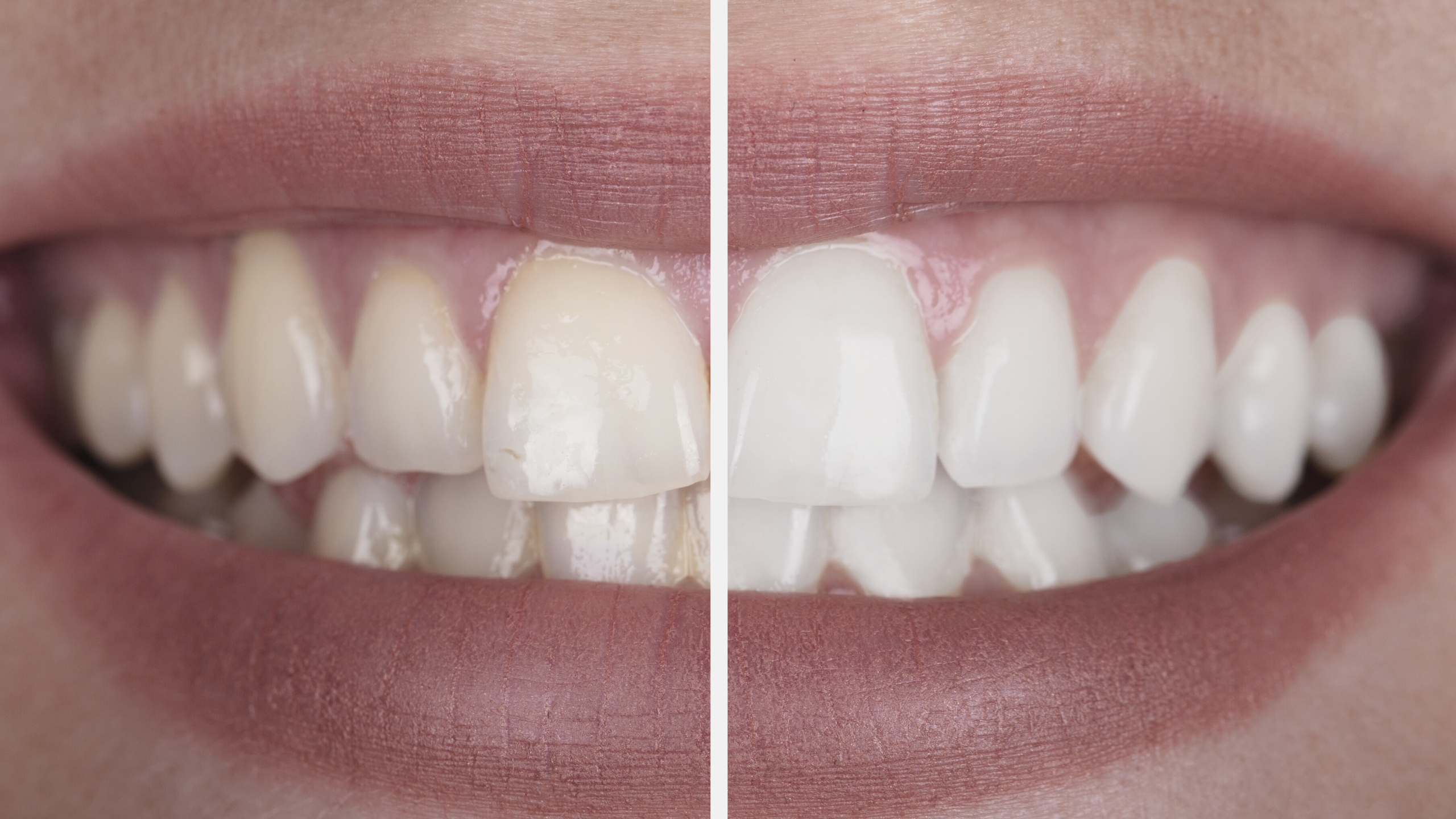 Tips for Whiter Teeth Longer – RDHopes.com